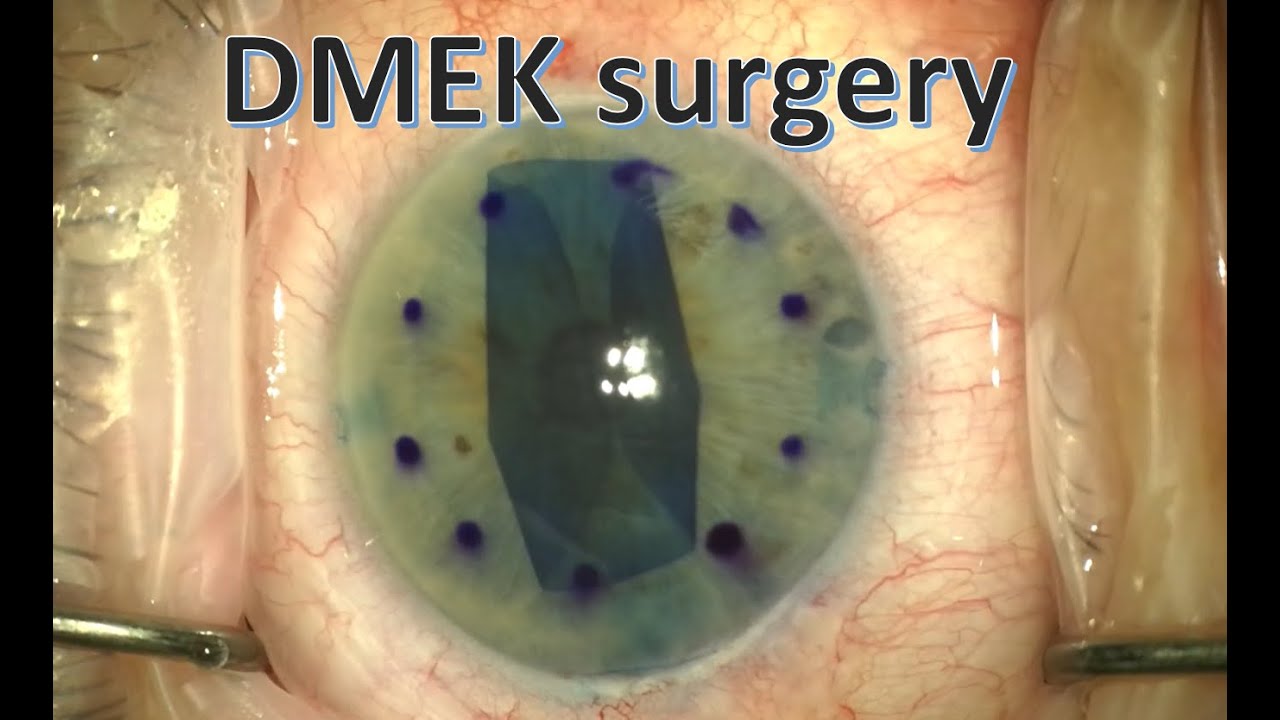 DMEK corneal transplant for the treatment of corneal endothelial ...