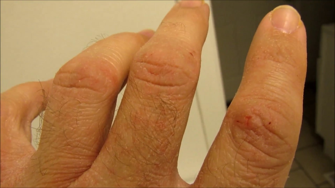 Ichthyosis Vulgaris Hands