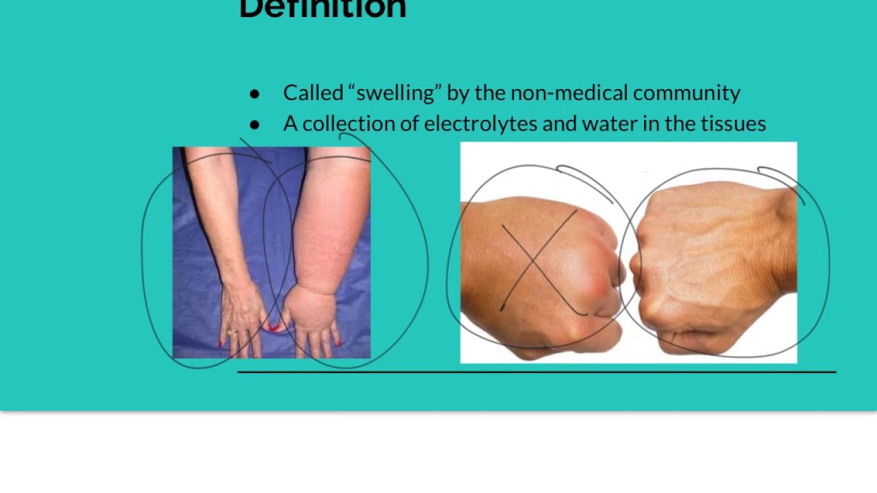 edema test ppt movie.mp4 - YouTube