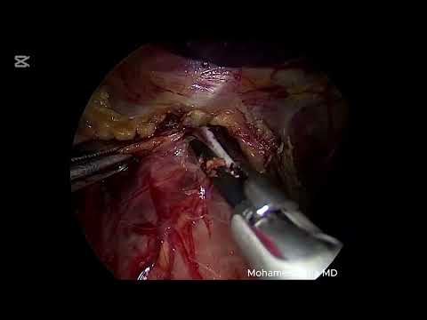 Laparoscopic Heller cardiomyotomy and Dor's fundoplication - YouTube