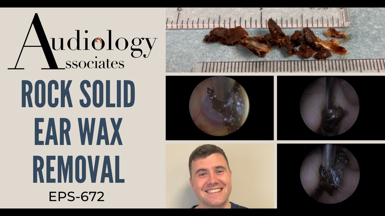 ROCK SOLID EAR WAX REMOVAL - EP672 - YouTube