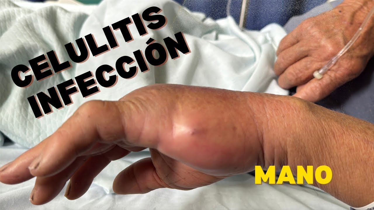 Infección de Mano - Celulitis - YouTube