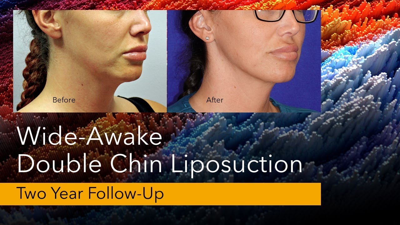 Wide-Awake Double Chin Liposuction - Two Year Follow Up - YouTube