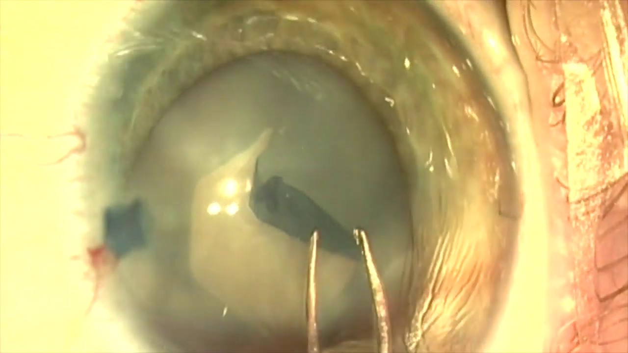 Dense traumatic cataract/PPV/Yamane by Steven G. Safran MD - YouTube