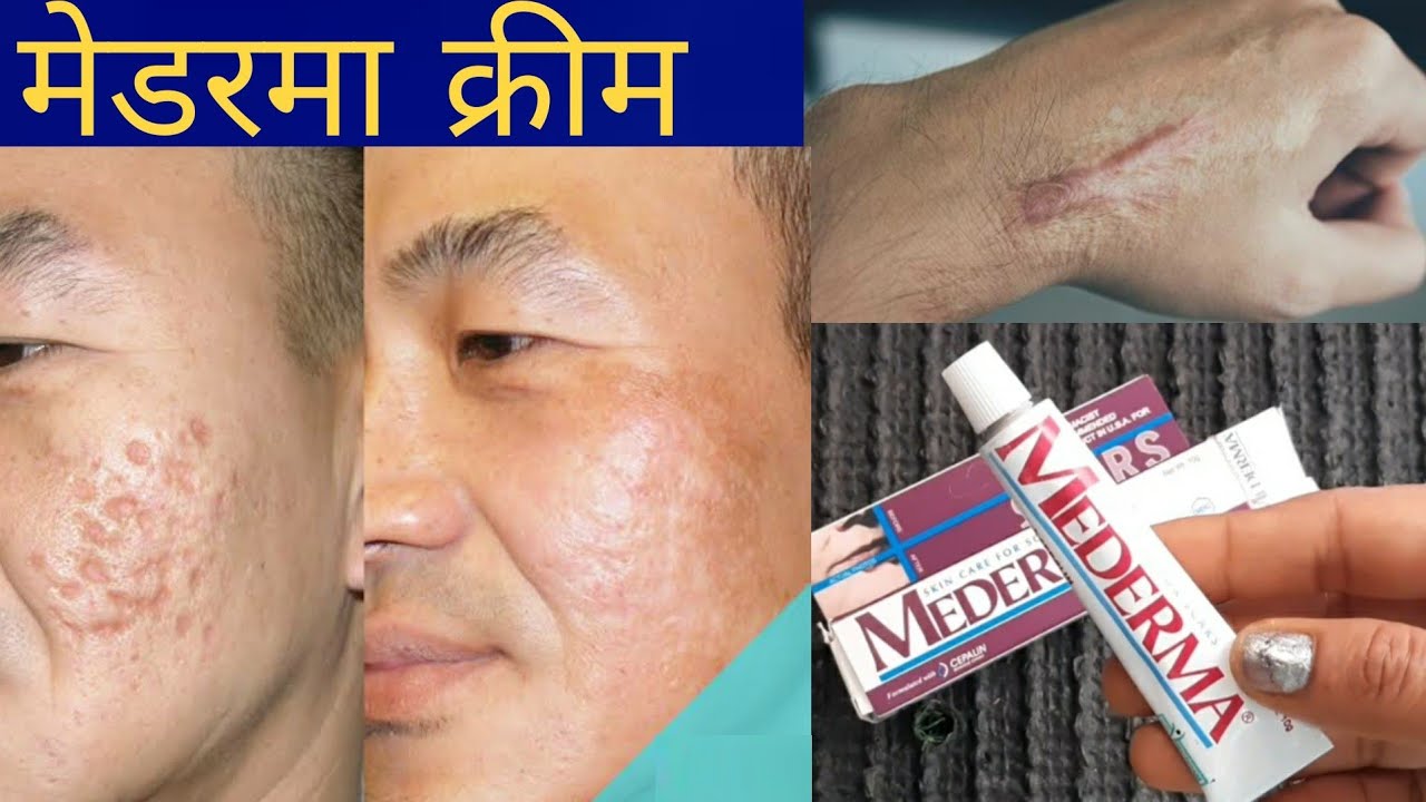 Mederma Skin care For Scars||Mederma cream Remove Acne Scars|surgery ...