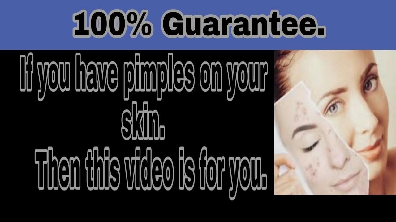 how can remove acni/home remedies/ - YouTube