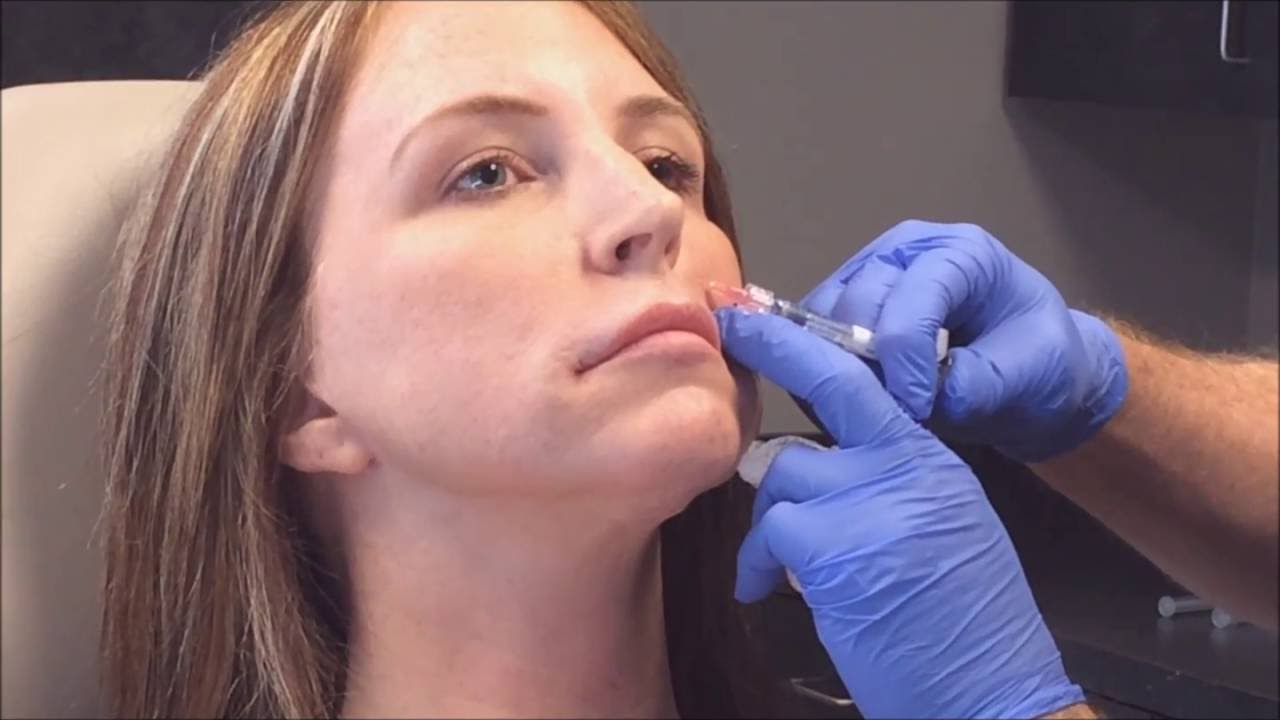 Restylane Lip Injections Performed at Southern Plastic Surgery in ...