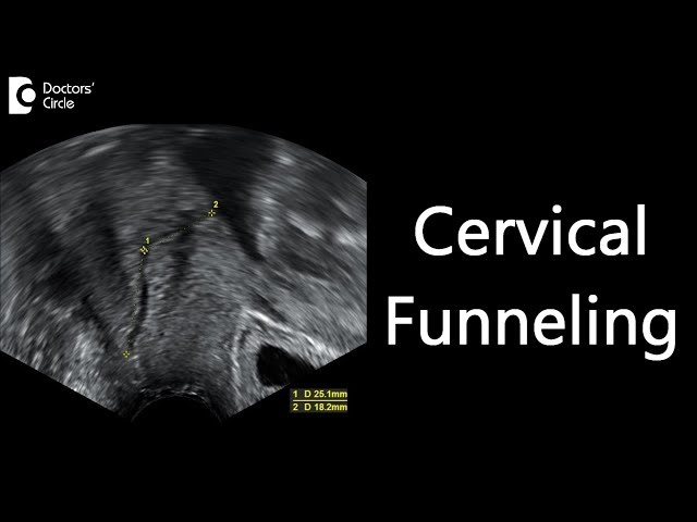 Causes Of Cervix Funneling A New Paradigm For The Role Of Smooth