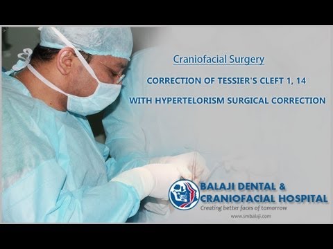 Correction of Tessier's Cleft 1, 14 with hypertelorism - Surgical ...
