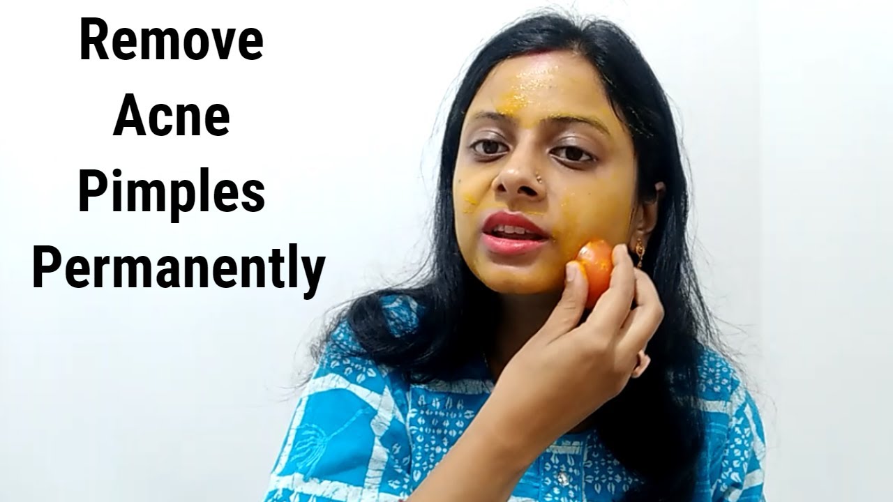 How to Remove Acne, Pimples and Dark Spots Permanently - YouTube