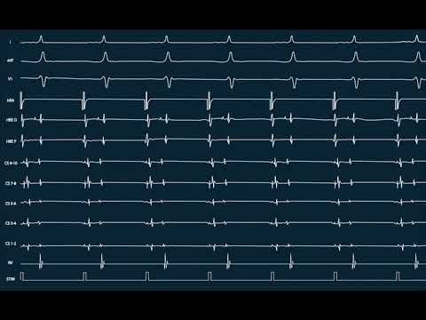 Atrial burst pacing 01 Converted - YouTube