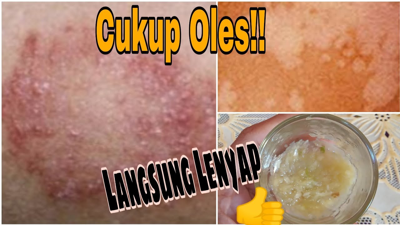 Mujarab!! Penyakit Kulit Panu, Kadas Kurap Kutu Air dan Gatal-gatal ...
