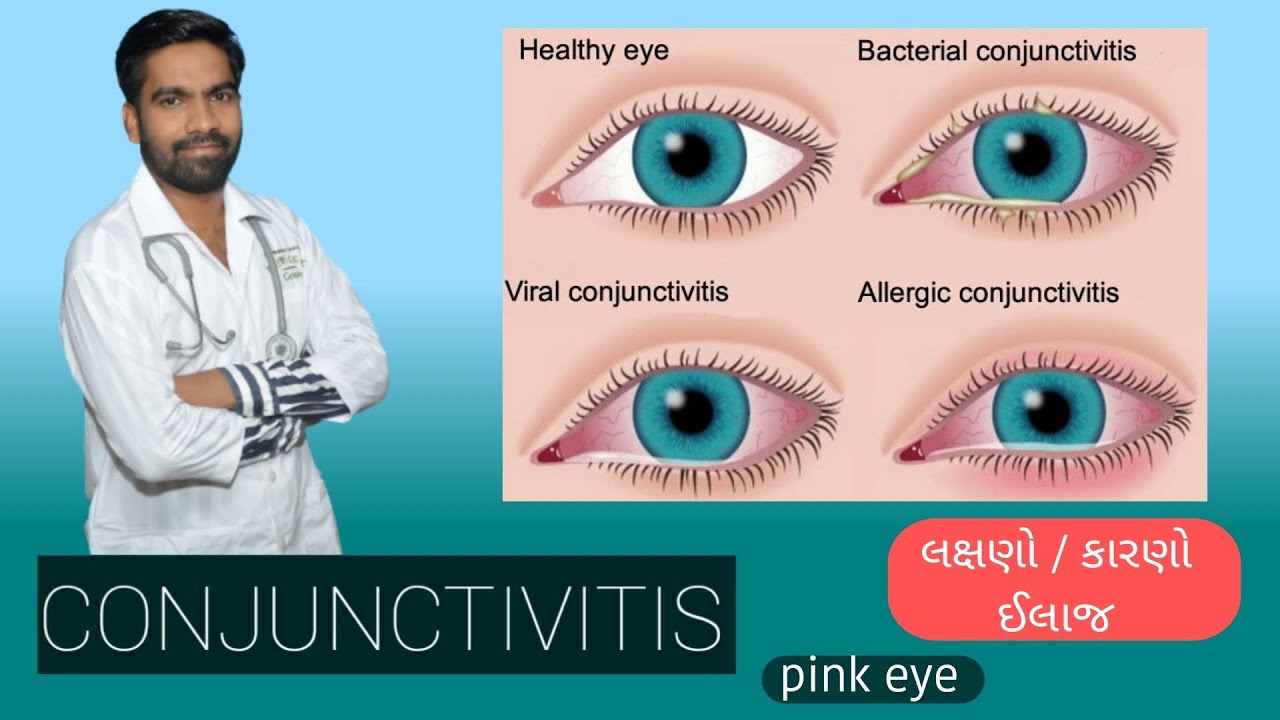conjunctivitis (pink eye) :- cause , symptoms, treatment. - YouTube