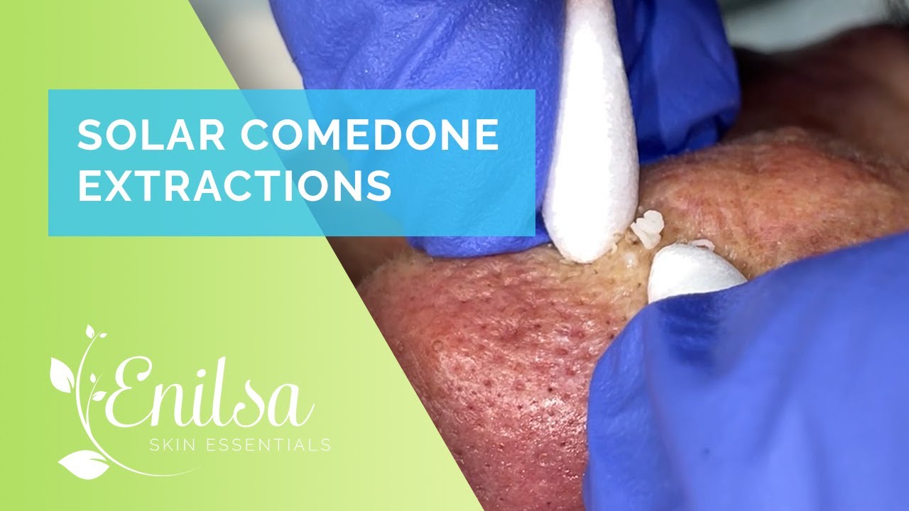 Solar Comedone Extractions - YouTube