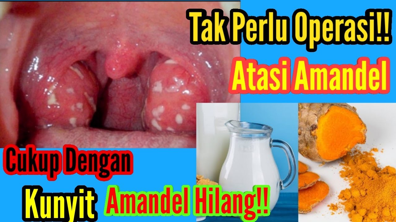 Dokter Terkejut!!! Amandel/Radang Tenggorokan Sembuh Total Hanya Dengan ...