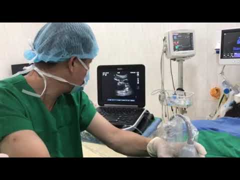 Thoracolumbar Interfascial Plane Block (TLIP Block) - YouTube