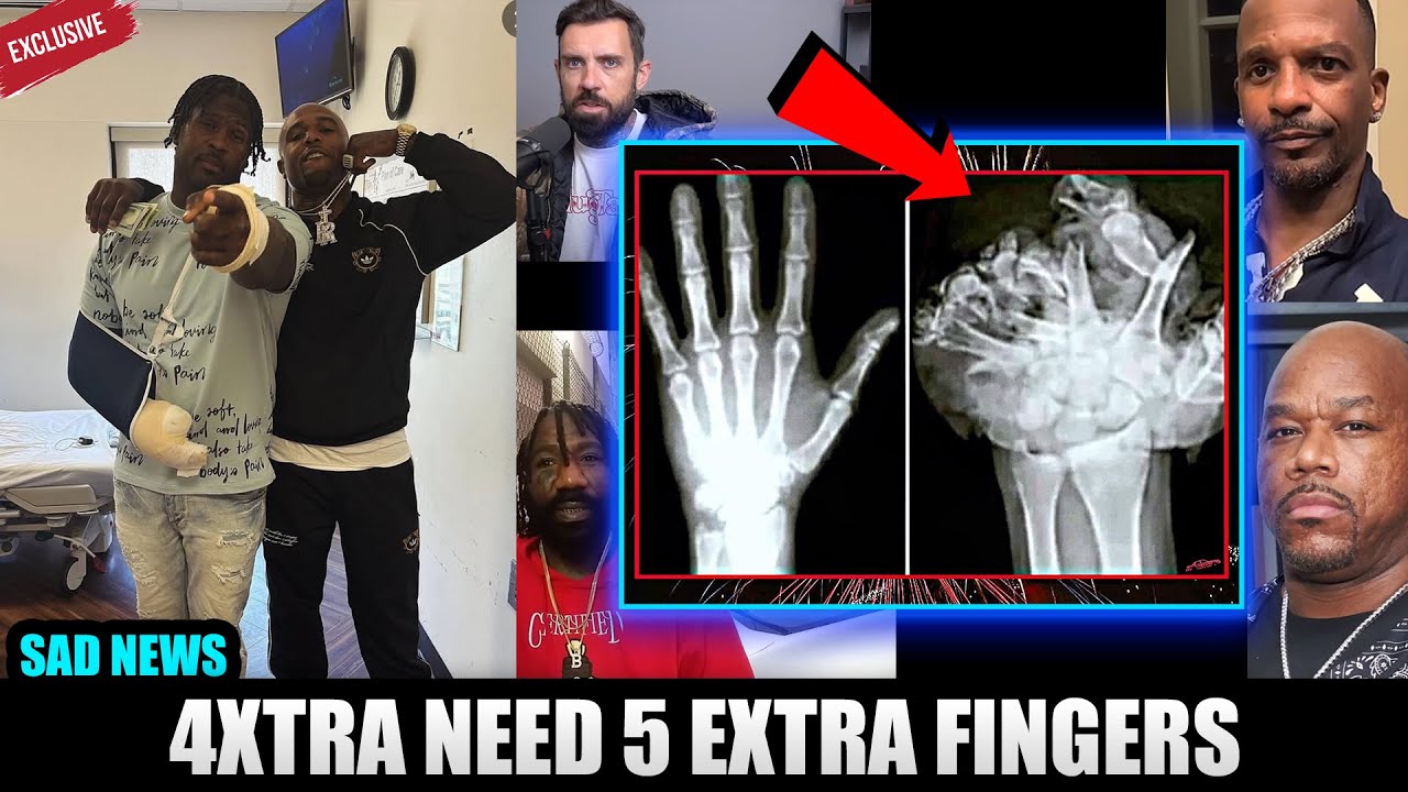 4xtra Need 5 Extra Fingers his Hand is Completely Gone (UPDATE) - YouTube