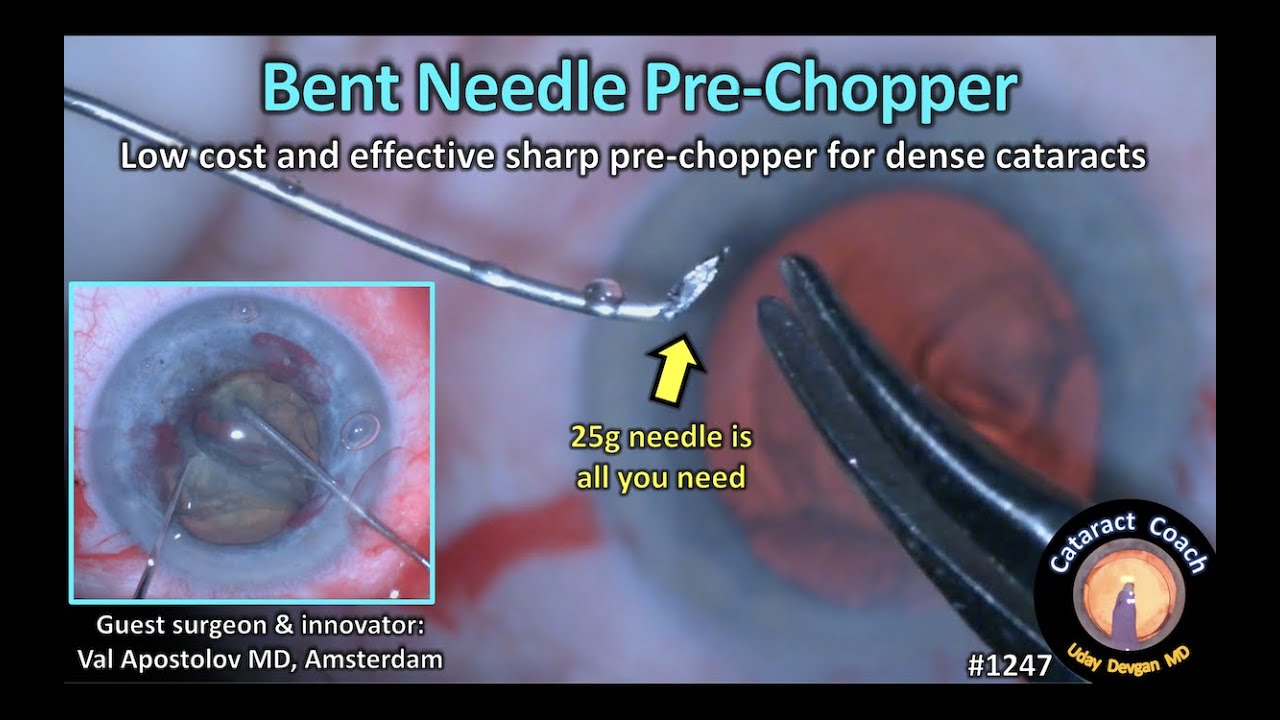 CataractCoach 1247: needle pre-chopper for cataract surgery - YouTube