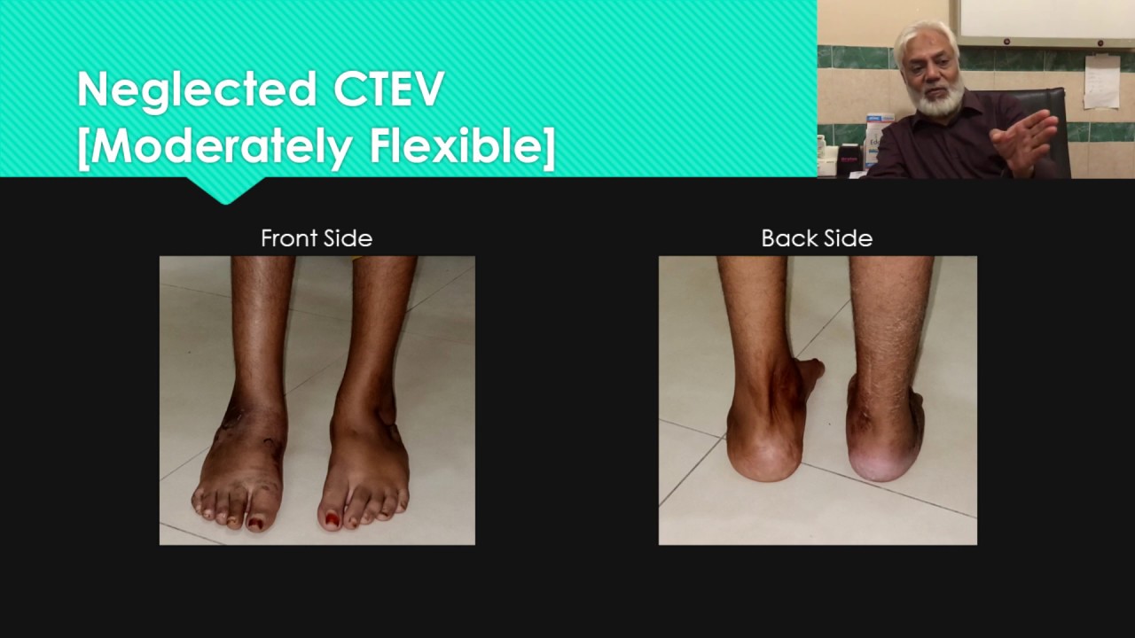 Management of Neglected CTEV - Clubfoot (Lecture by Dr.Afzal Hussain ...