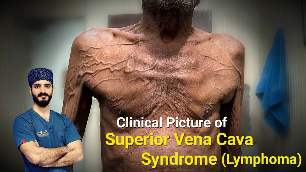 Superior Vena Cava Obstruction - Dr Tayyab Riaz Ch - YouTube