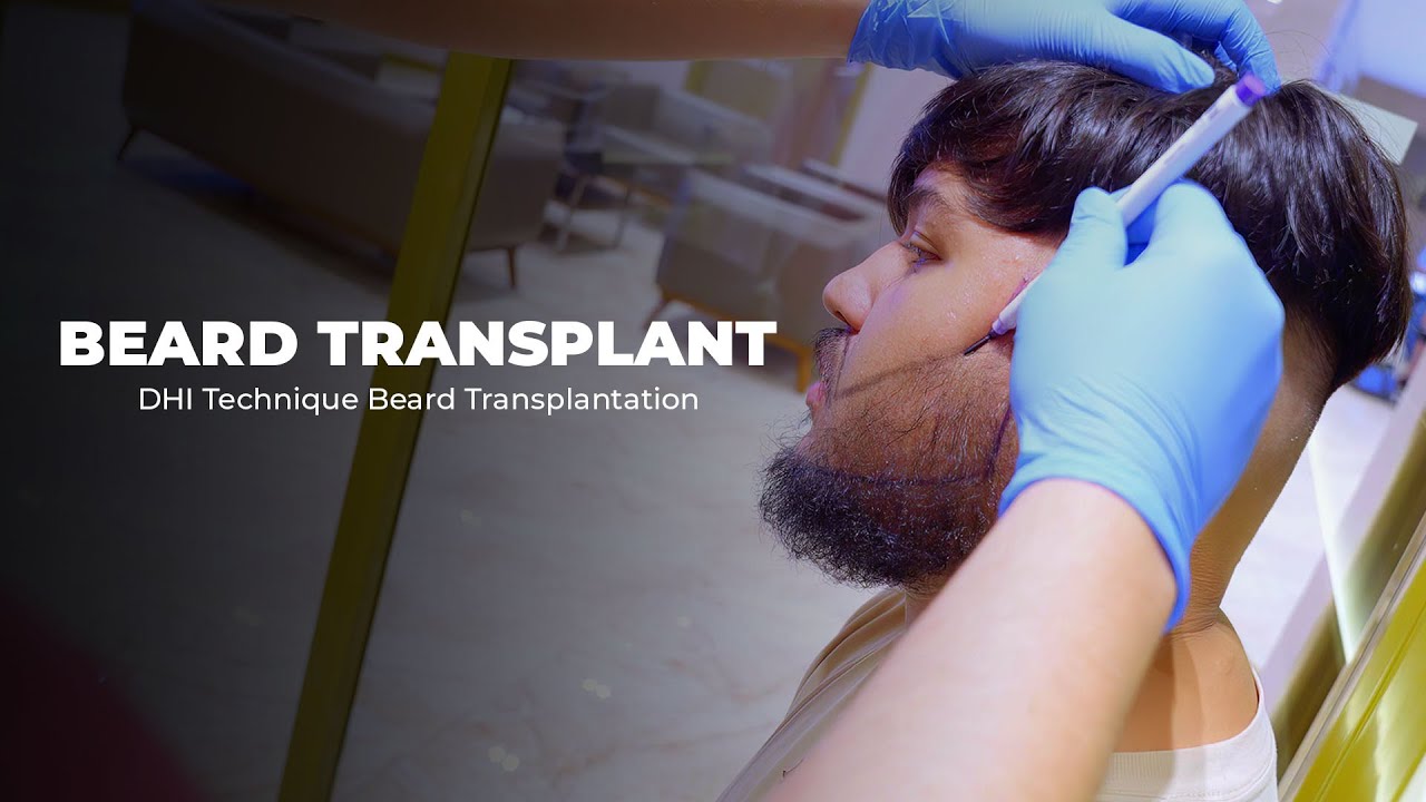 Beard Hair Transplant - DHI Technique Beard Transplantation - YouTube