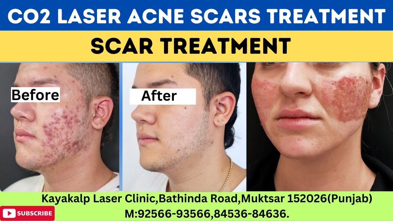 CO2 Laser Acne Scars Treatment | Independence Day Offer | Scar ...