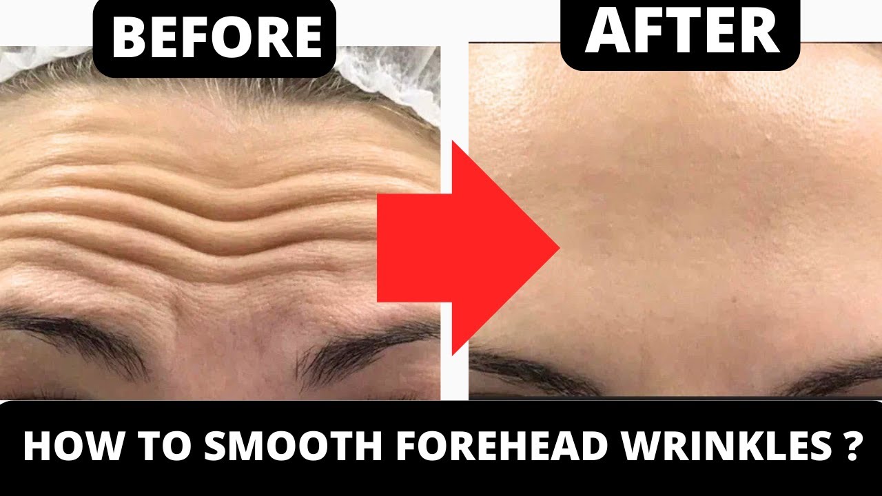 Tighten Saggy Jowls: Face Yoga for Sagging Skin, Crow's Feet & Forehead ...