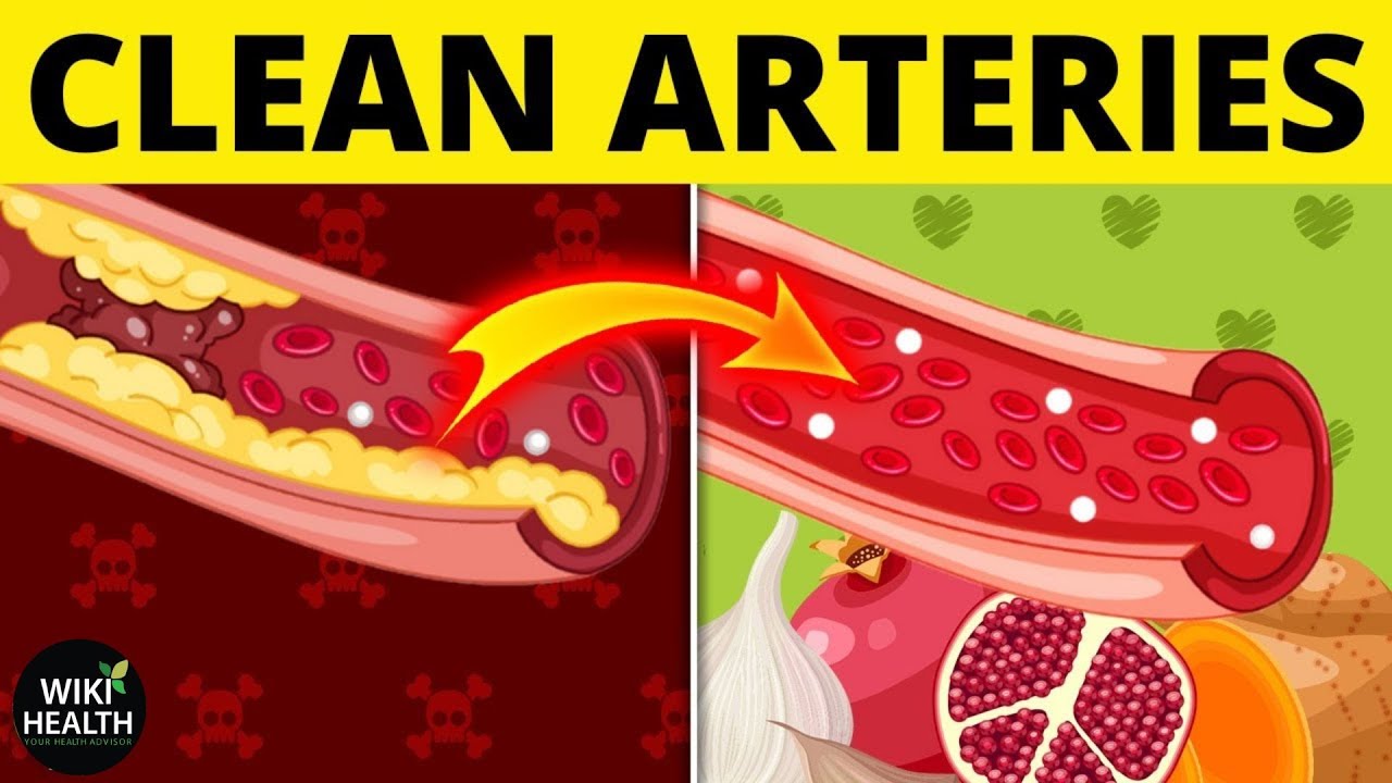 Top 5 Foods That Unclog Arteries Naturally And Prevent Heart Attack