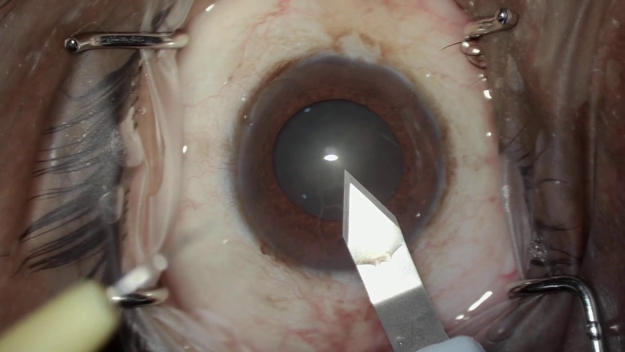 Soft cataract is hard to operate..unedited video - YouTube