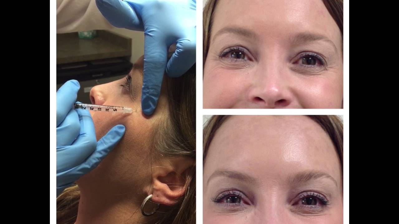 Dysport to treat Crow's Feet - YouTube