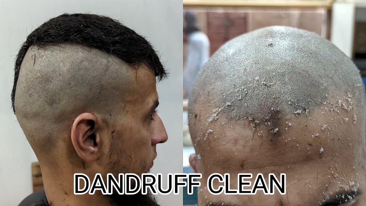 Attractive dandruff clean head shave straight razor,how to remove ...