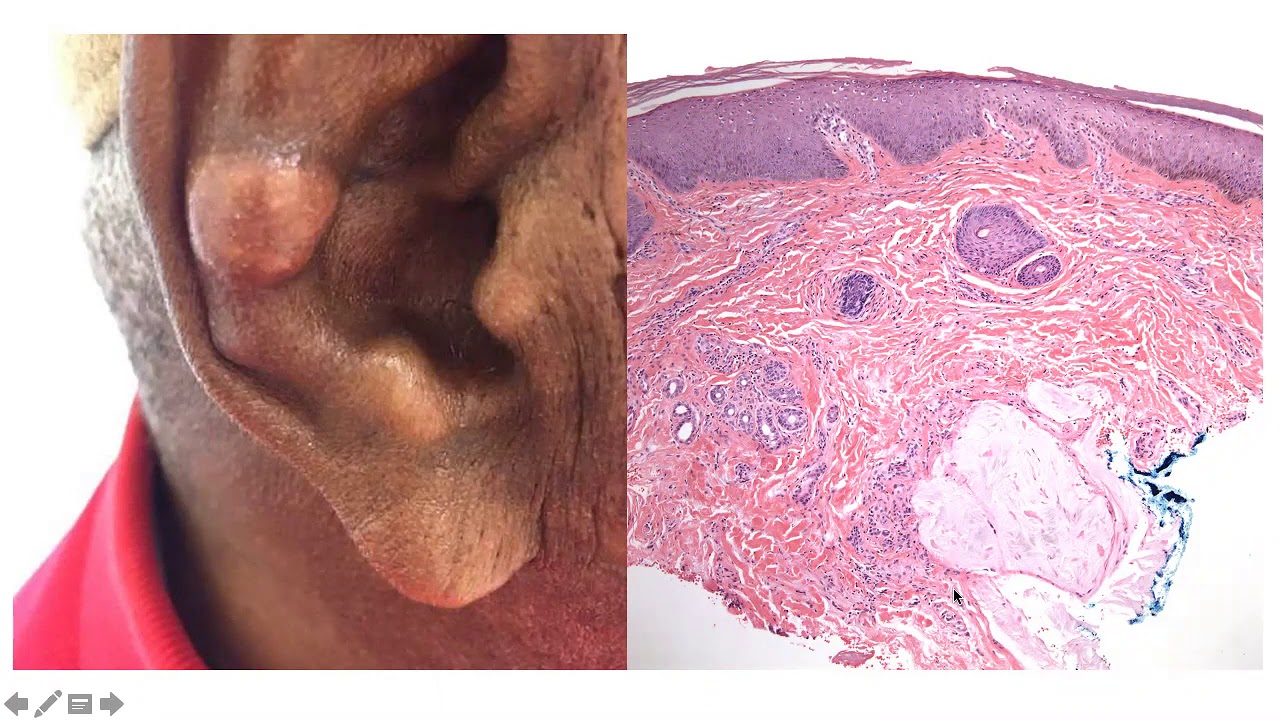 DP60 episode 201 ear nodule - YouTube