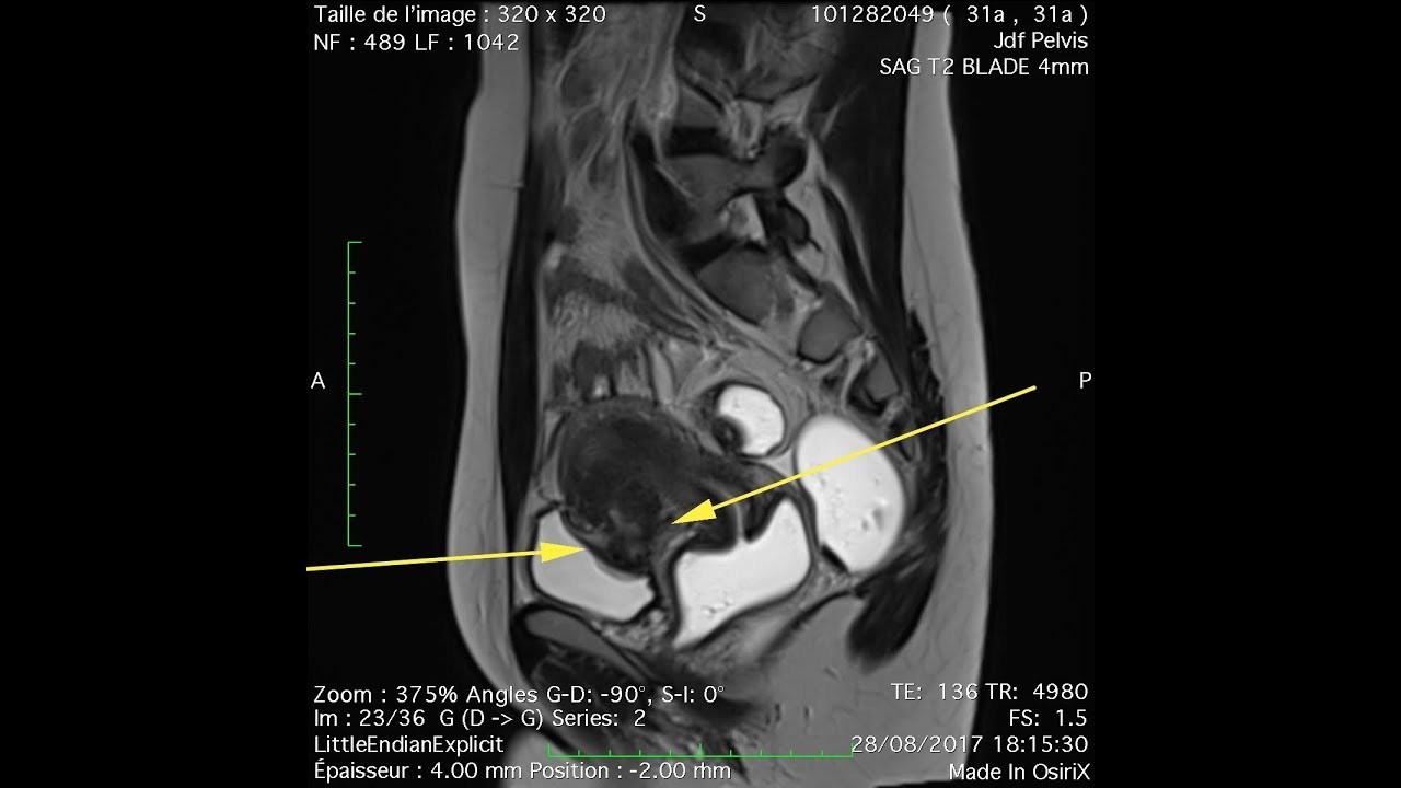 Resection of bladder nodule close to left ureter - YouTube