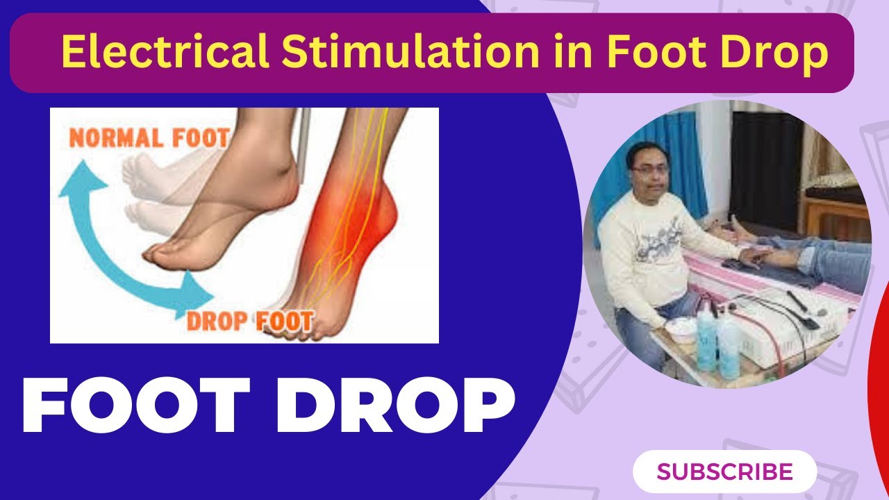 Foot Drop-Electrical Stimulation in Foot Drop|फुट ड्रॉप कैसे ठीक करें ...