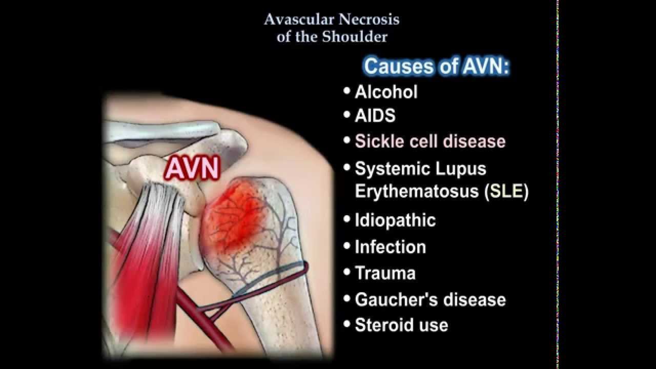AVN Of The Shoulder - Everything You Need To Know - Dr. Nabil Ebraheim ...