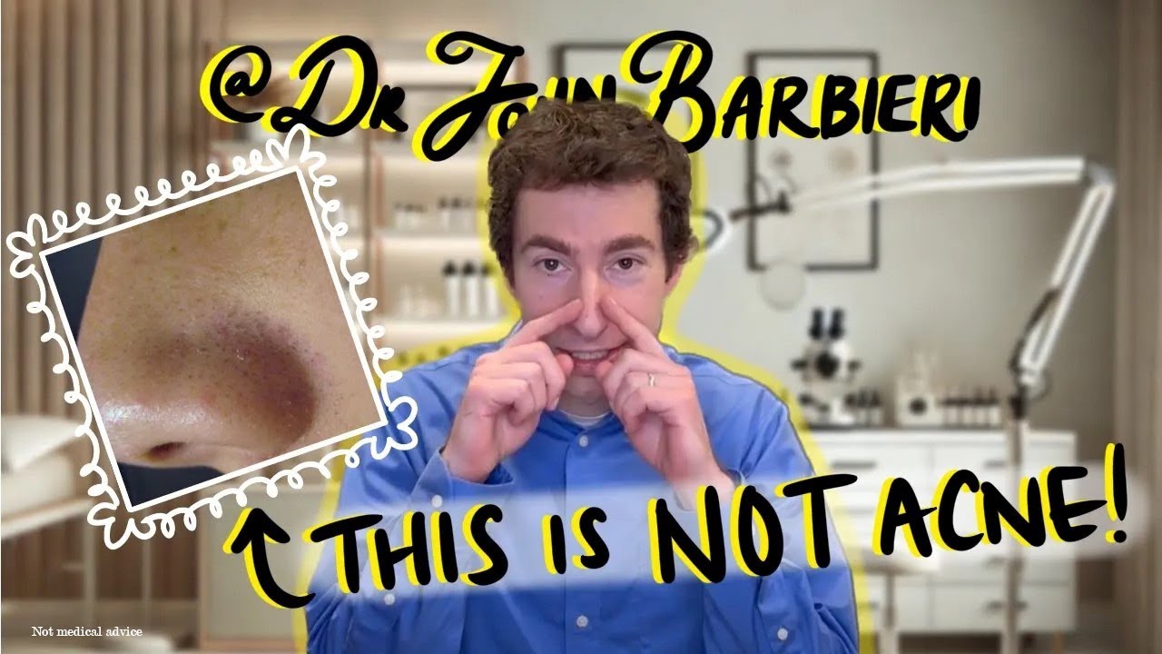 Get Rid of Blackheads on the Nose | Sebaceous Filaments | Dermatologist ...