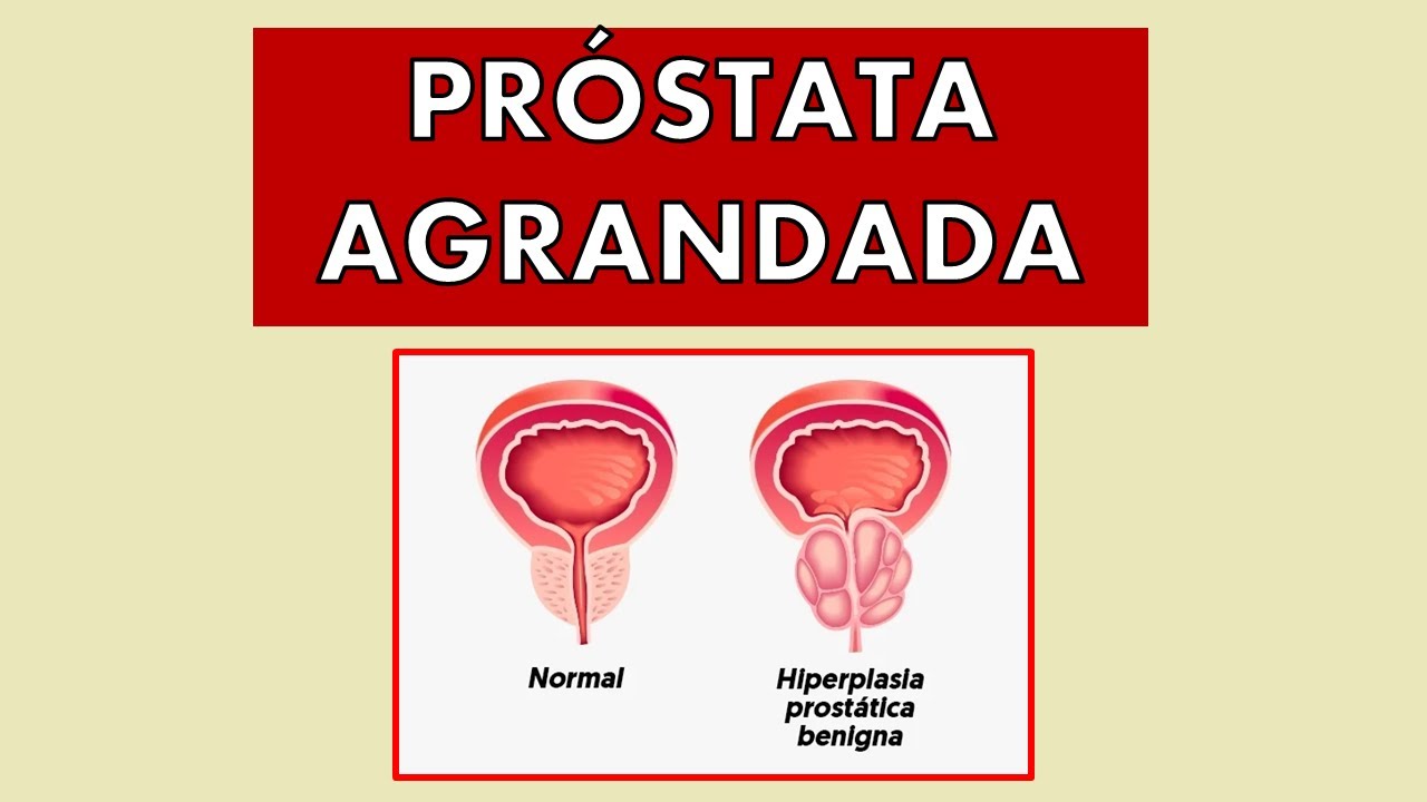 🔴 PROBLEMAS de PRÓSTATA AGRANDADA | SÍNTOMAS, DIAGNÓSTICO Y TRATAMIENTO ...
