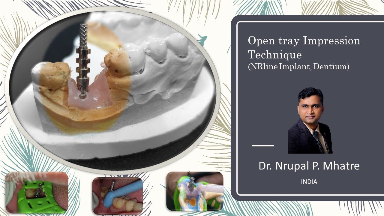 Open tray Impression Technique in Implantology - YouTube