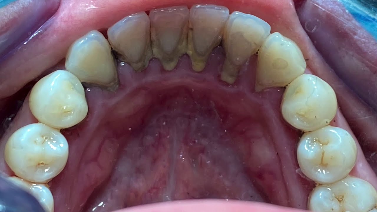 What is deep cleaning? Why do I need a deep cleaning? - YouTube