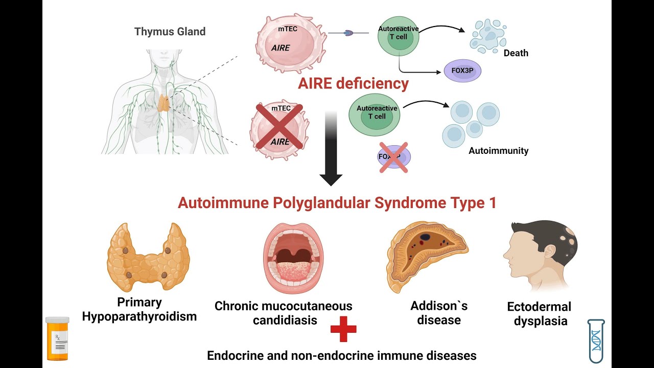 Polyglandular Syndrome Or Autoimmune Polyglandular Syndrome APS ...