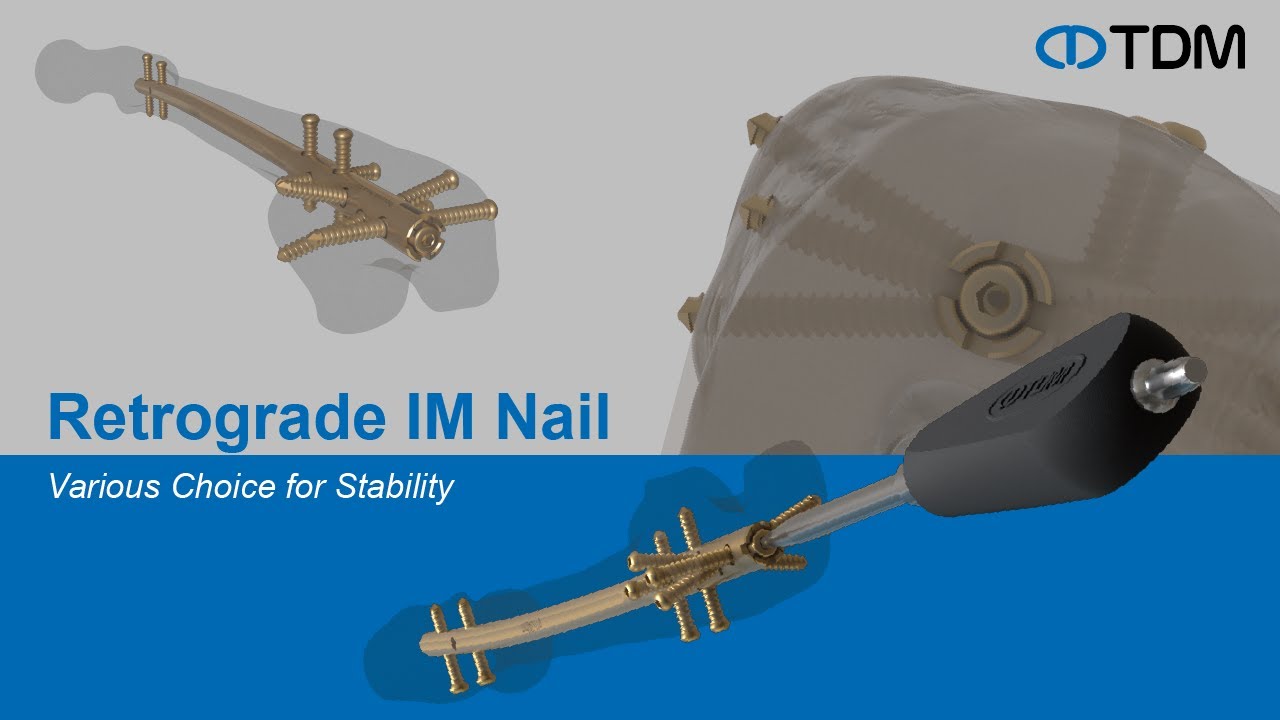 [TDM Korea] Retrograde IM Nail - YouTube