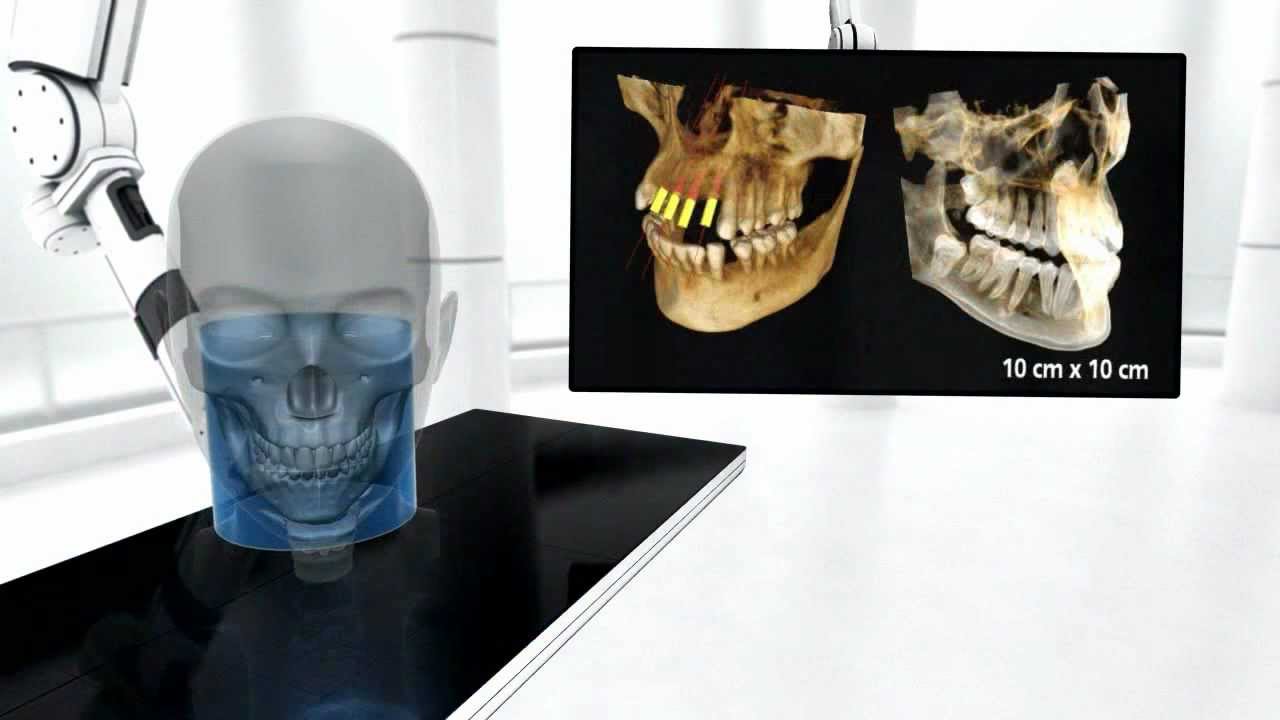 Carestream CS 9300.avi - YouTube