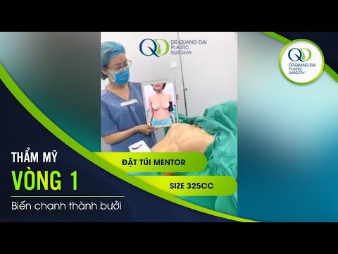 Nâng ngực túi Mentor - Sự lựa chọn hoàn hảo dành cho nàng!