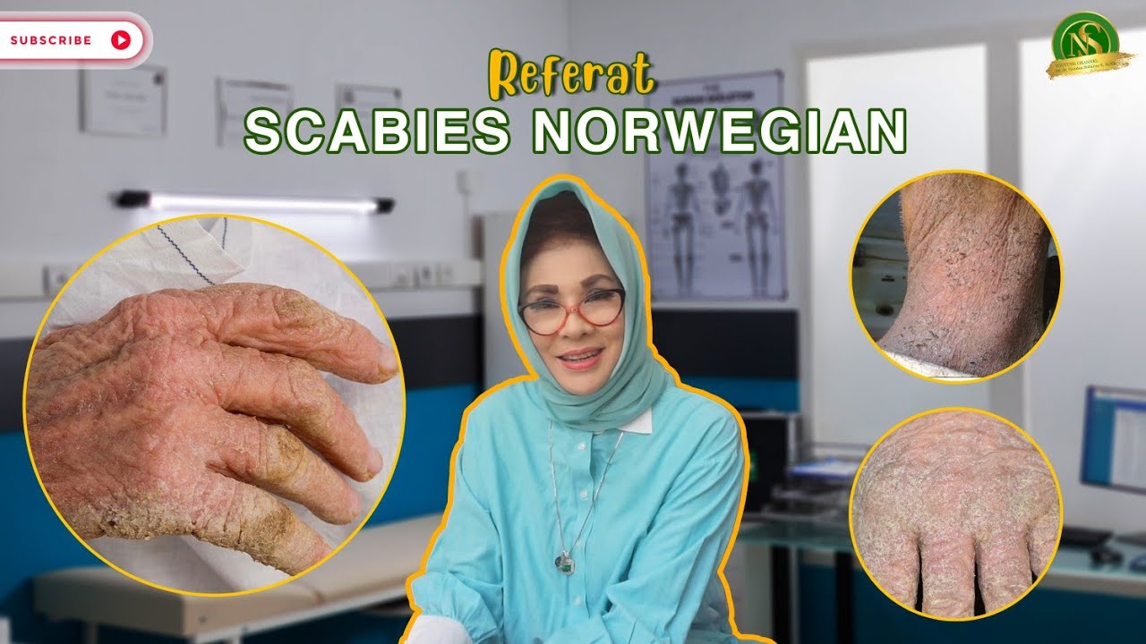 JURNAL READING REFERAT SCABIES NORWEGIAN - YouTube