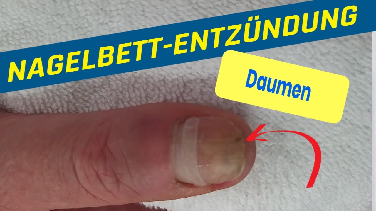 Nagelbettentzündung am Daumen durch NAGELKAUEN oder REISSEN - YouTube