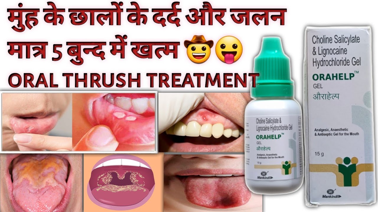 orahelp gel uses in hindi / मुंह के छाले की दवा / oral thrush treatment ...