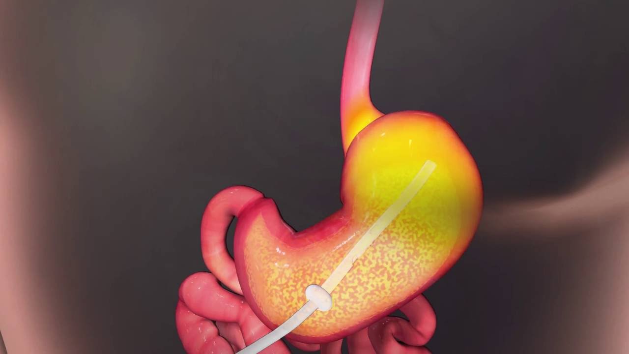 AspireAssist Aspiration Process - YouTube