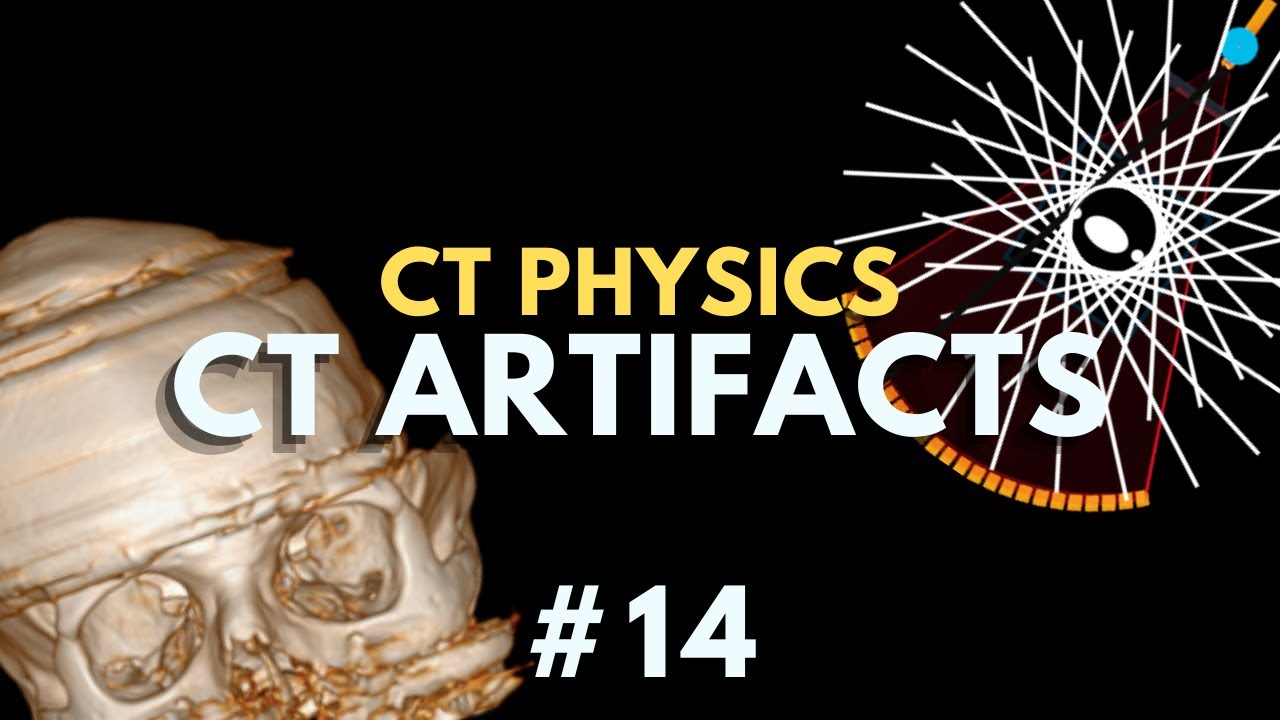 Common CT Artifacts | Computed Tomography Radiology Physics Course #14 ...