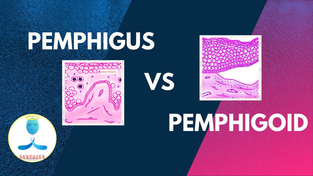 Pemphigus Versus Pemphigoid | Pemphigus Vulgaris versus Mucous Membrane ...