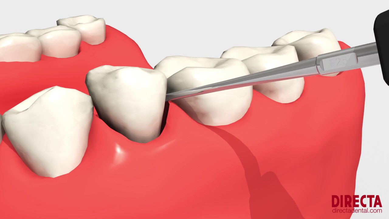 lux forte DIRECTA DENTAL - YouTube